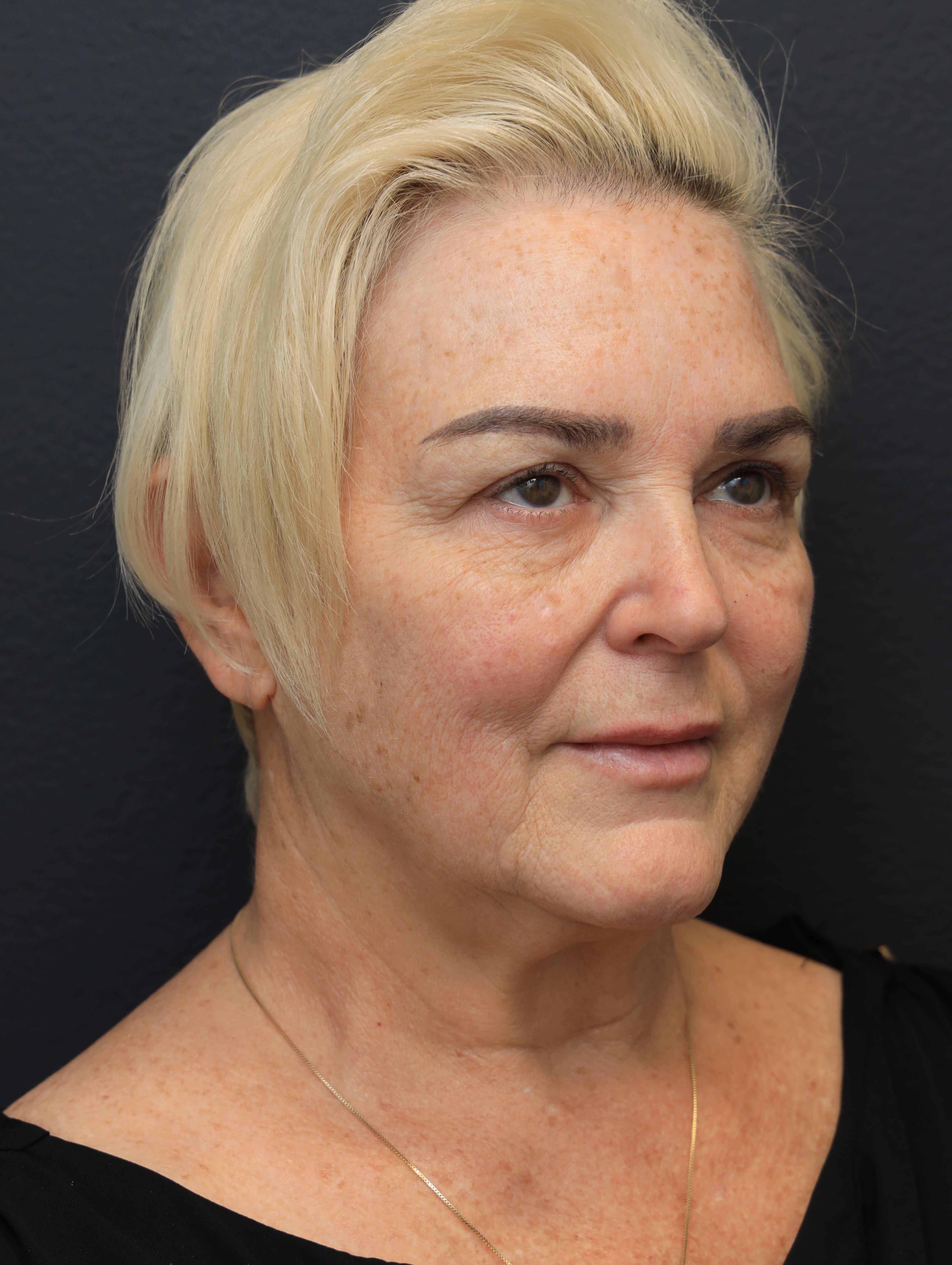 Deep Plane Face + Neck Lift, Upper Blepharoplasty & Lip Lift | Case 106675